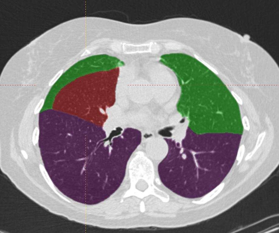 Lung Quantitation - Q3D Imaging Lab | UCLA Health