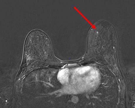 Breast MRI Findings: Focus and Mass - Radiology | UCLA Health
