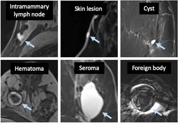 MRI Sequences and How to Read a Breast MRI and BI-RADS - Radiology ...