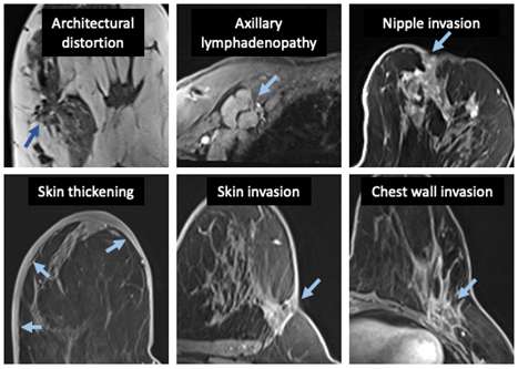 MRI Sequences and How to Read a Breast MRI and BI-RADS - Radiology | UCLA Health