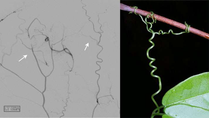 Intracranial Arterial Stenosis - Interventional Neuroradiology | UCLA ...