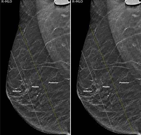 Breast Lesion Localization - Radiology | UCLA Health