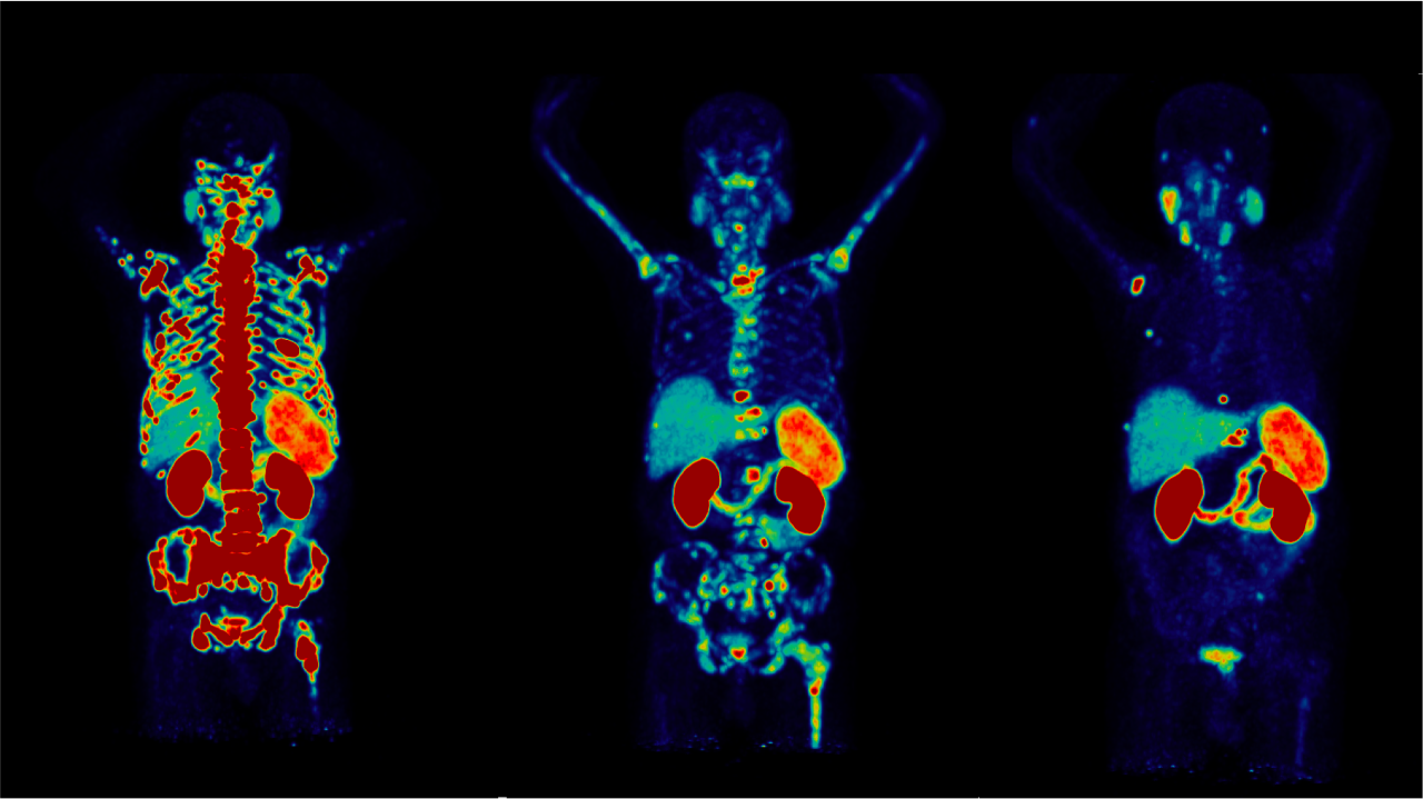Research - Nuclear Medicine | UCLA Health