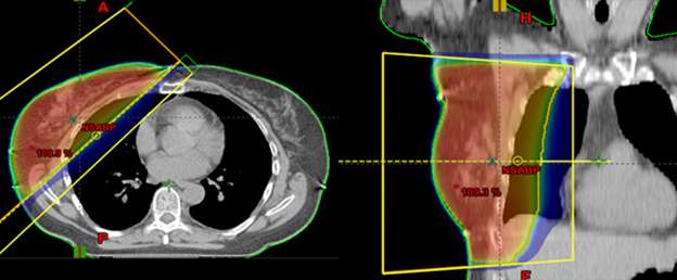 Breast Cancer – Brachytherapy - Radiation Oncology | UCLA Health
