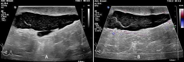 Seromas and Hematomas in the Breast - Radiology | UCLA Health