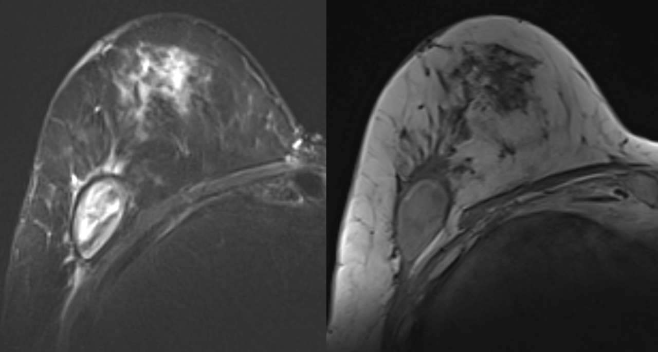 Post-Surgical Fluid Collections: Causes, Symptoms, and Management ...