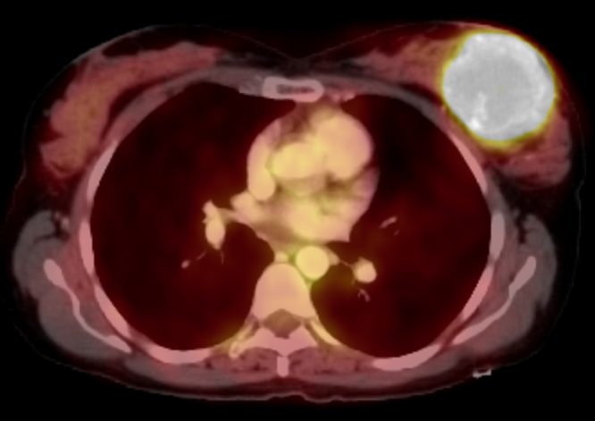Case: Sarcoma - Radiology | UCLA Health