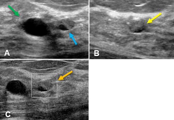 Simple Cyst, Clustered Microcysts, Complicated Cyst - Radiology | UCLA ...