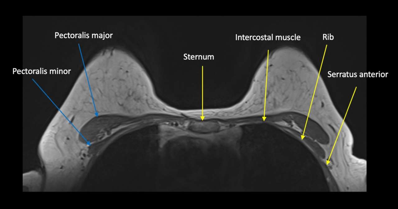 Case: Chest Wall Invasion - Radiology | UCLA Health