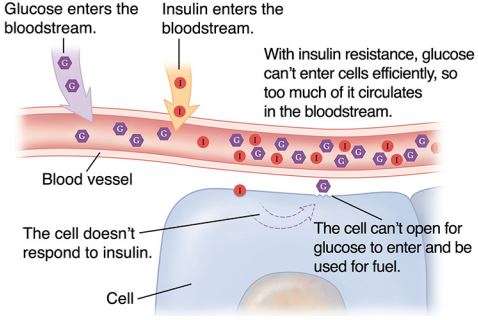 Type 2 Diabetes - Diabetes | UCLA Health