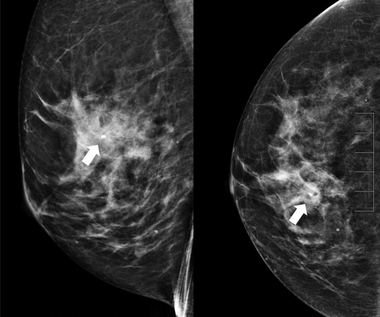 How to Perform: Stereotactic (Mammographic Guided Biopsy) - Radiology ...
