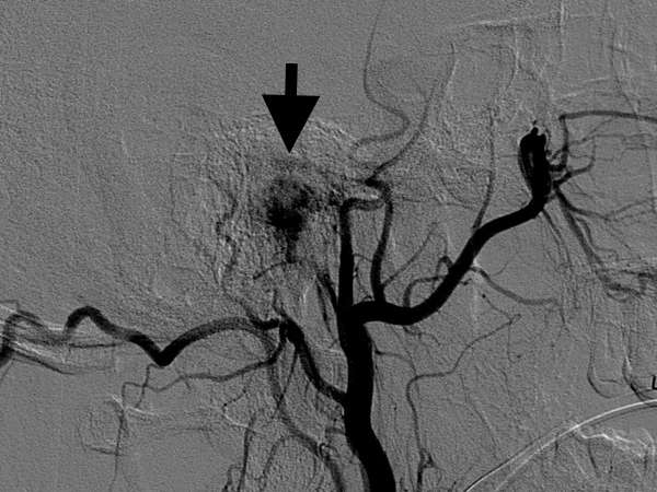Embolization - Interventional Neuroradiology | UCLA Health
