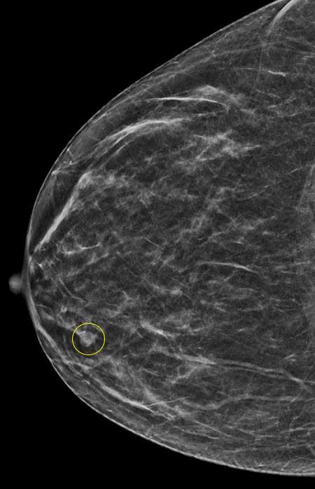 Breast Ductal Anatomy and Function - Radiology | UCLA Health