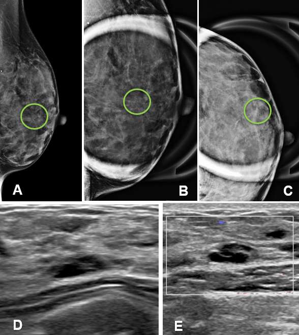 Simple Cyst, Clustered Microcysts, Complicated Cyst - Radiology | UCLA ...