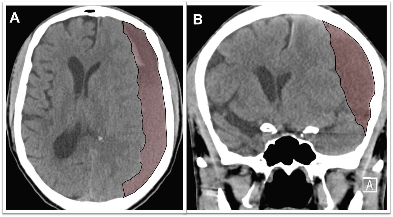 Middle Meningeal Artery Embolization for Chronic Subdural Hematoma ...