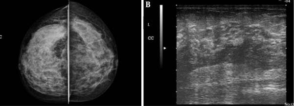 Case: Mastitis - Radiology | UCLA Health