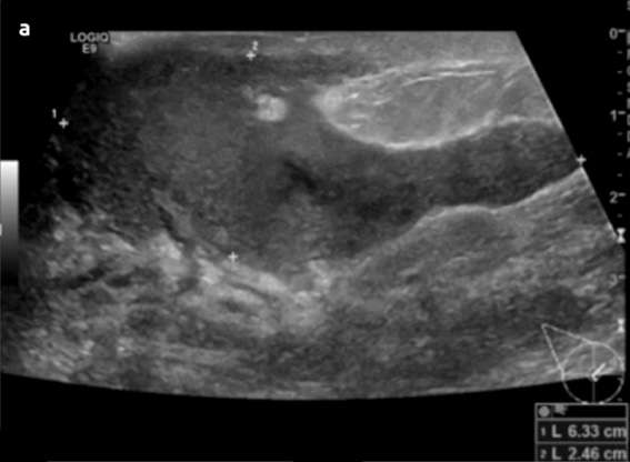 Case: Mastitis - Radiology | UCLA Health