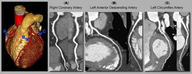 Coronary CTA - Radiology | UCLA Health