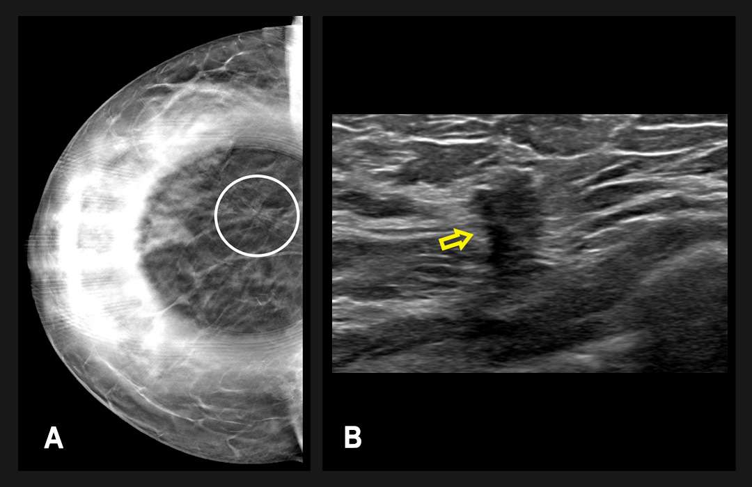 Case: Architectural Distortion - Radiology | UCLA Health