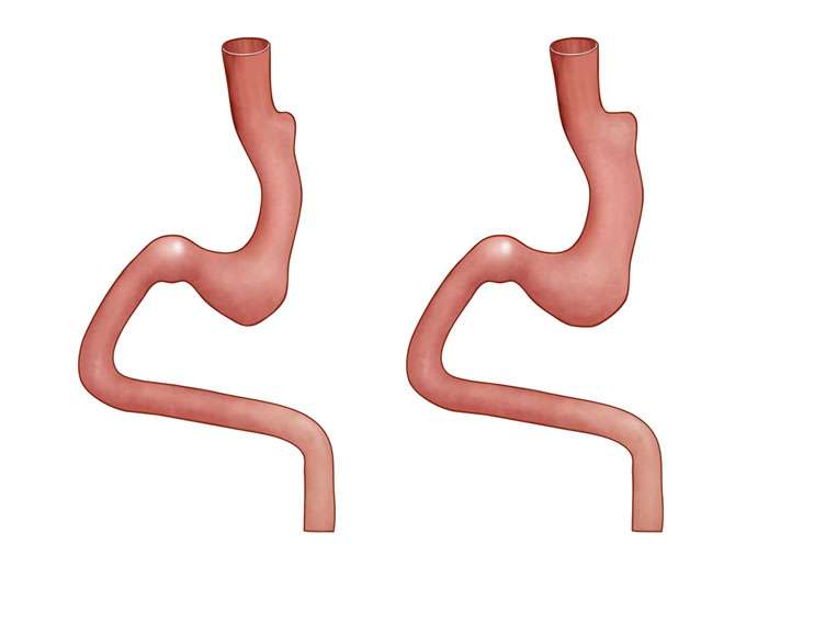 Sleeve Weight Regain - Bariatric Surgery | UCLA Health