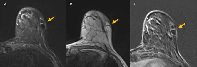 Case: Fat Necrosis of the Breast - Radiology | UCLA Health