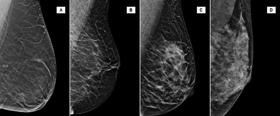 Breast Composition: The Impact of Dense Breasts - Radiology | UCLA Health