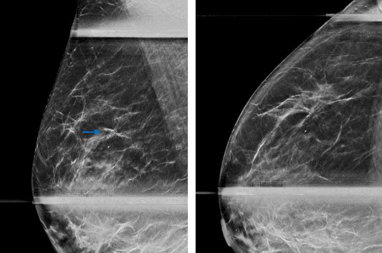 Radial Sclerosing Lesions - Radiology | UCLA Health