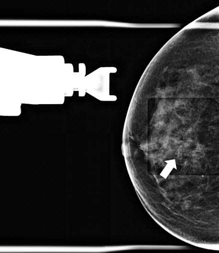 How to Perform: Stereotactic (Mammographic Guided Biopsy) - Radiology ...