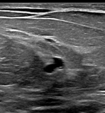 Radial Sclerosing Lesions - Radiology | UCLA Health