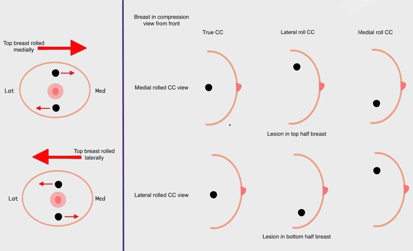 Breast Lesion Localization - Radiology | UCLA Health