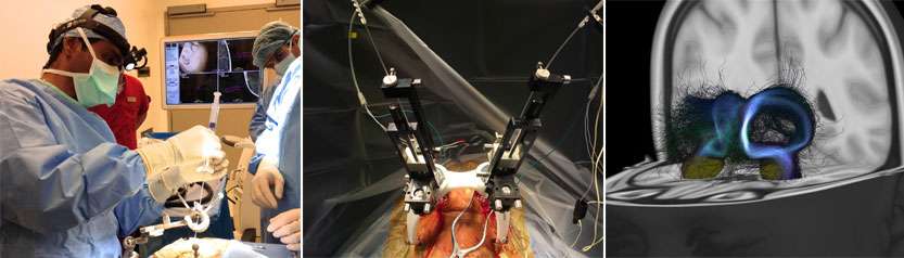 Surgical Neuromodulation and Brain Mapping Lab - Neurosurgery | UCLA Health