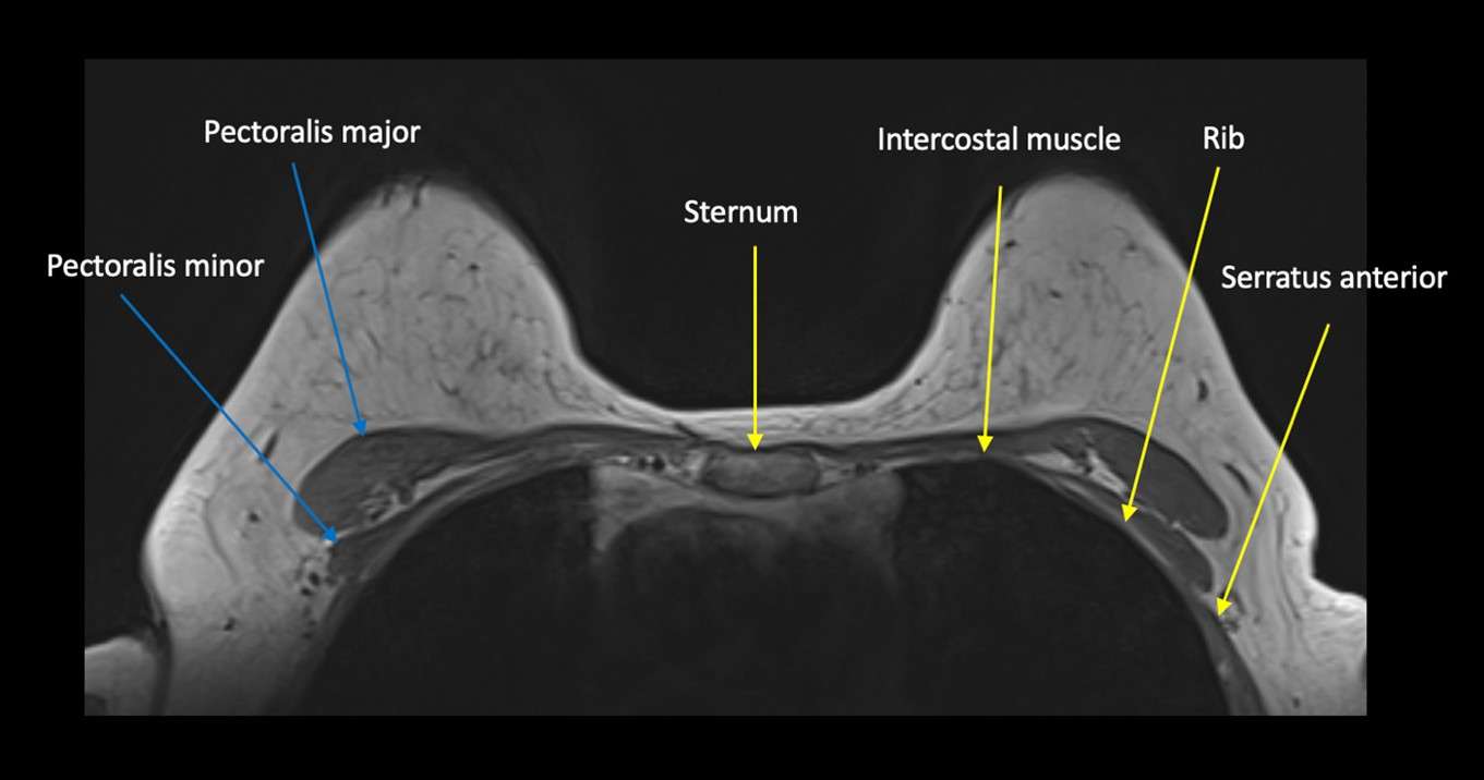 Case: Chest Wall Invasion - Radiology | UCLA Health