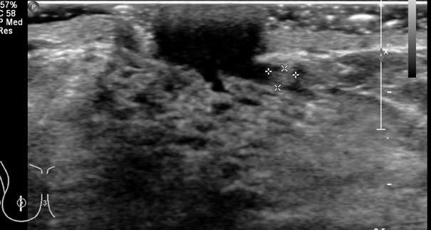 How to Perform: Ductograms - Radiology | UCLA Health