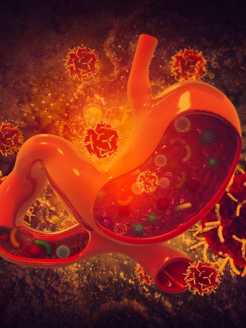 Stomach Cancer Treatment - Los Angeles, CA | UCLA Health Jonsson ...