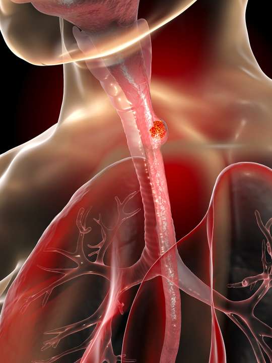 Esophageal Cancer Care and Treatment | UCLA Health Jonsson ...