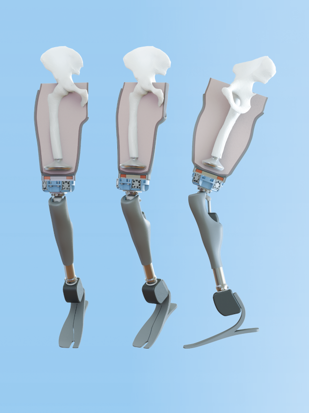 The ‘bionic possibilities’ of prosthetic advances | UCLA Health