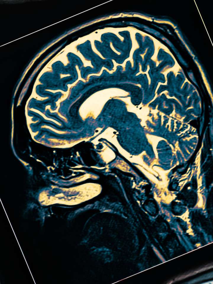 Cerebrovascular Neurosurgery | UCLA Health