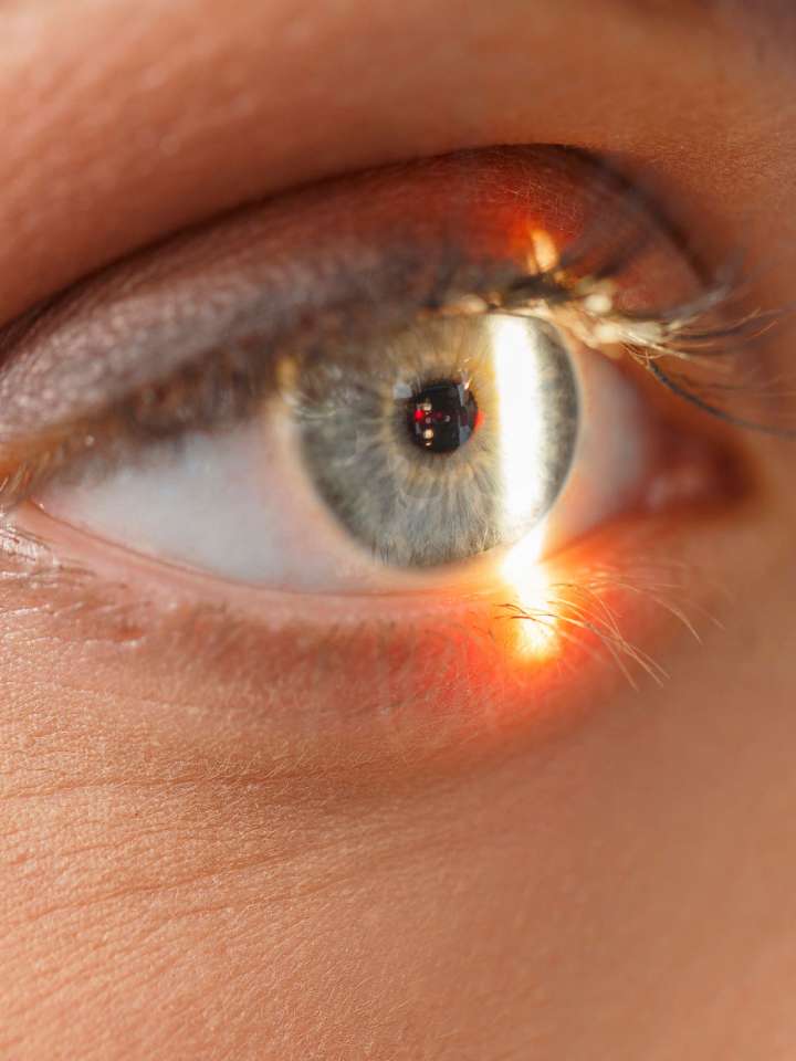 Corneal Disorders & Uveitis - Los Angeles, CA | UCLA Health