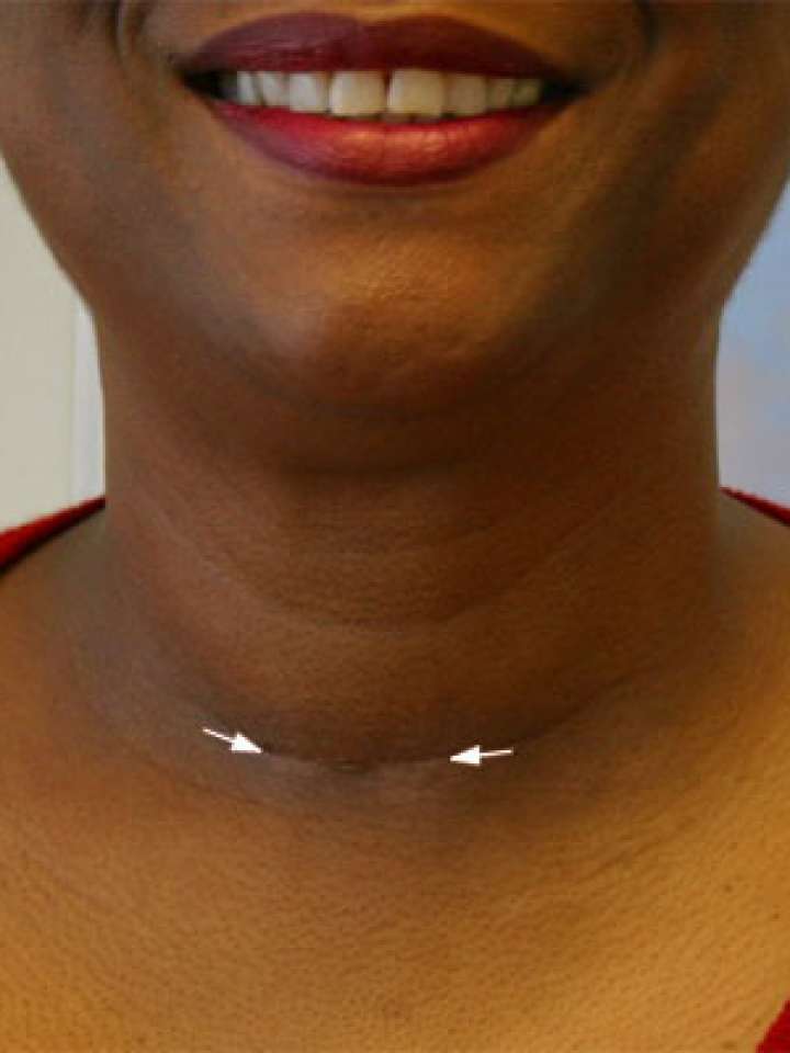 Thyroidectomy Scar Photos - Thyroid Cancer Surgery Scars - Endocrine ...