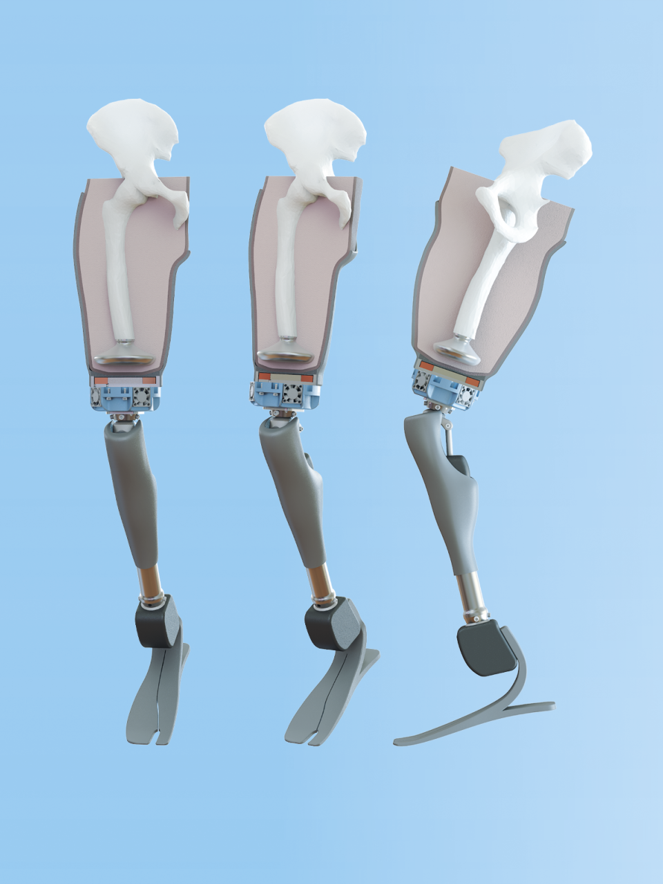 The ‘bionic possibilities’ of prosthetic advances | UCLA Health