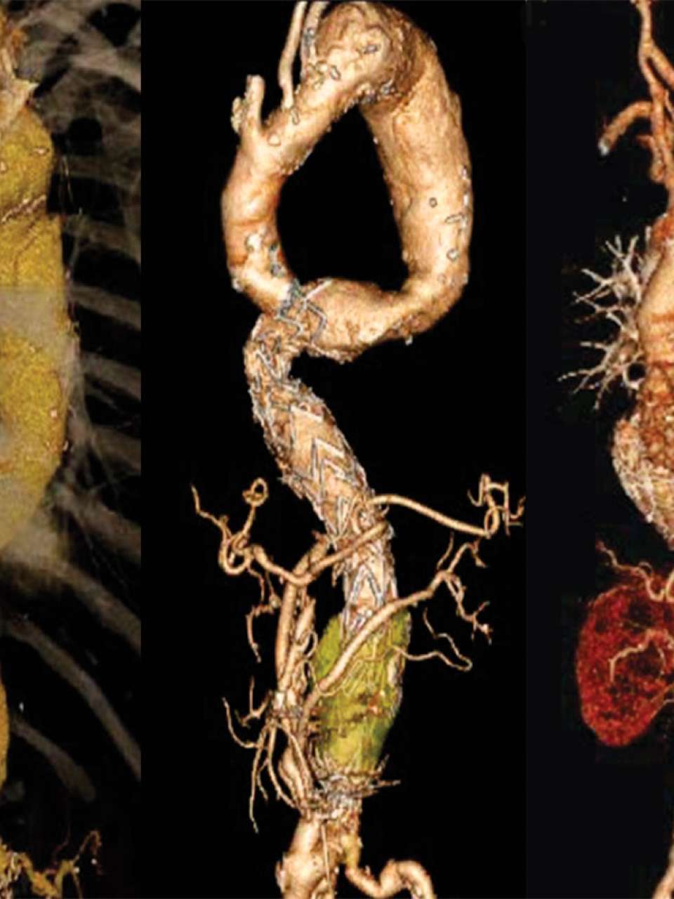 Aortic Care - Los Angeles, CA | UCLA Health